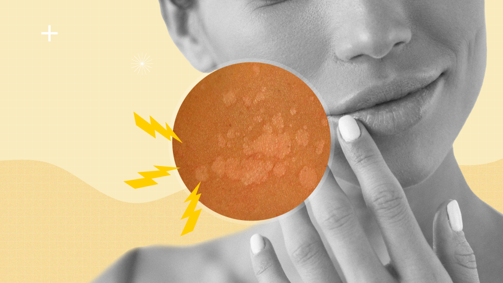 Cara Hilangkan Panau Di Muka – Glowwe